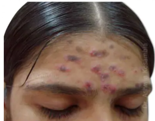 Apa itu acne atau jerawat ? - dr Agung Citra SpKK