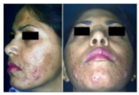 Apa itu acne atau jerawat ? - dr Agung Citra SpKK