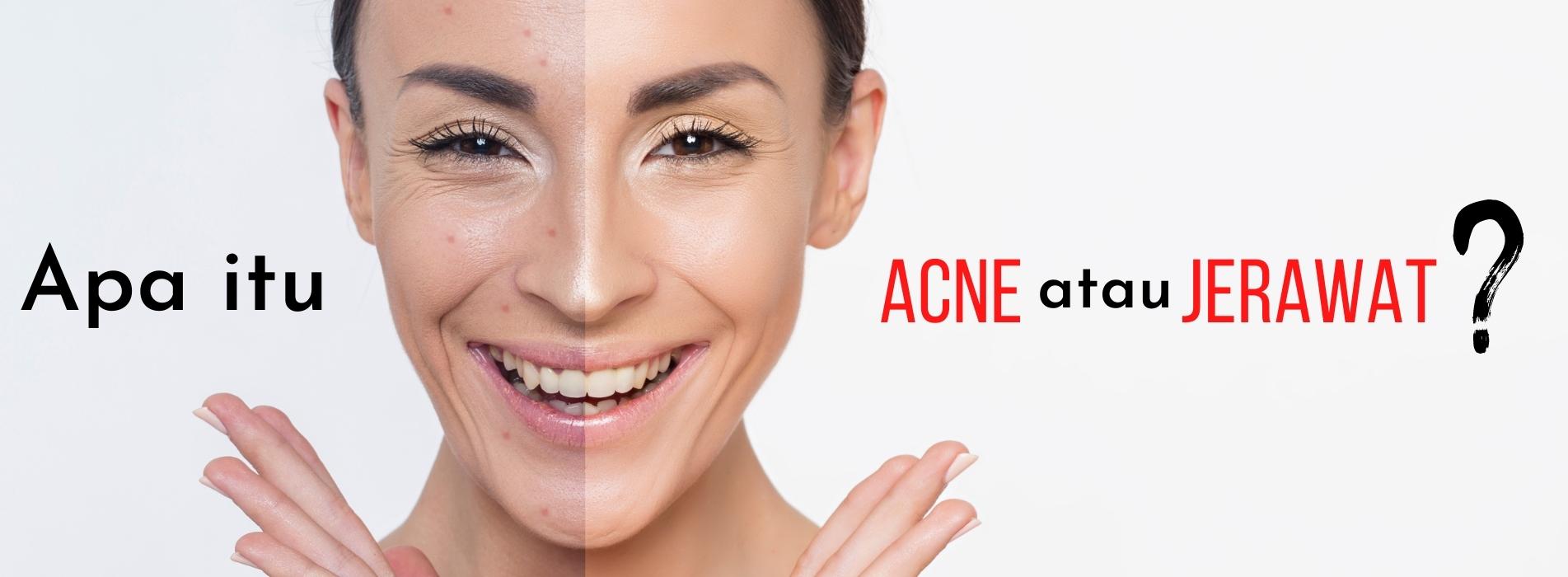 Apa itu acne atau jerawat ? - dr Agung Citra SpKK